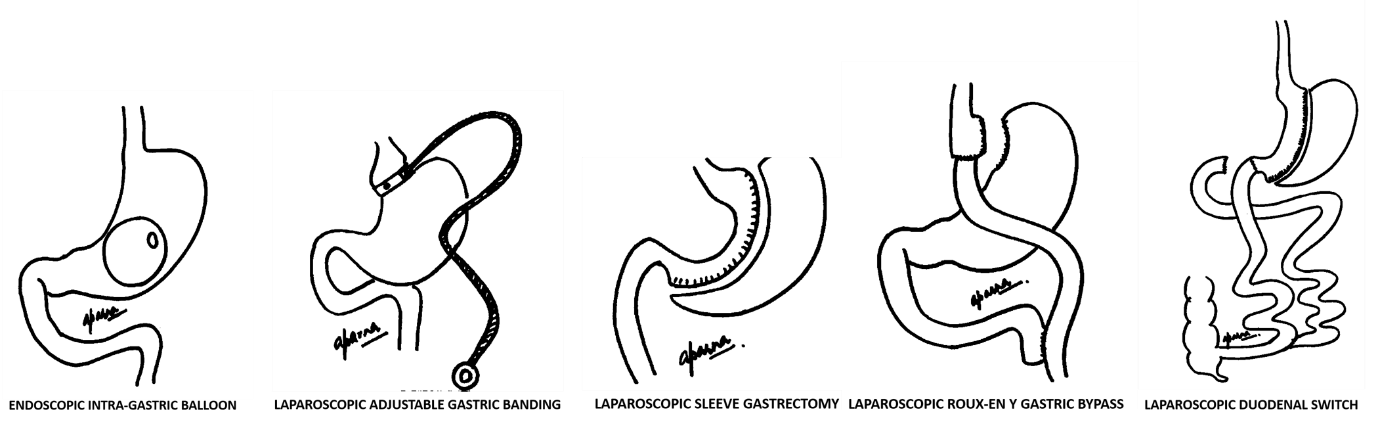 Everything You Need To Know About Metabolic Surgery