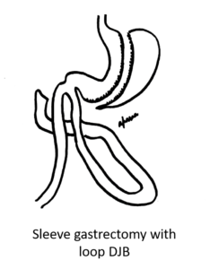 Sleeve Gastrectomy with Duodeno-Jejunostomy in Mumbai